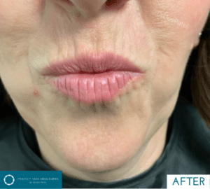 PLEXR | Before & After Photos | Perfect Skin Solutions