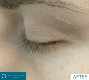 PLEXR | Before & After Photos | Perfect Skin Solutions
