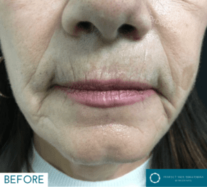 PLEXR | Before & After Photos | Perfect Skin Solutions