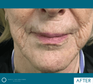 PLEXR | Before & After Photos | Perfect Skin Solutions