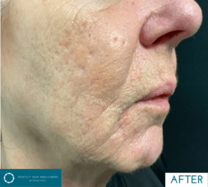 PLEXR | Before & After Photos | Perfect Skin Solutions