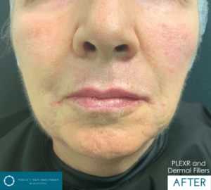 PLEXR | Before & After Photos | Perfect Skin Solutions