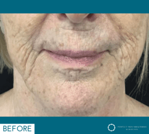 PLEXR | Before & After Photos | Perfect Skin Solutions
