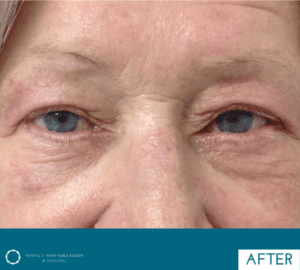 PLEXR | Before & After Photos | Perfect Skin Solutions