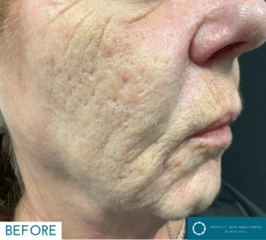 PLEXR | Before & After Photos | Perfect Skin Solutions