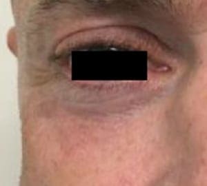 PLEXR | Before & After Photos | Perfect Skin Solutions