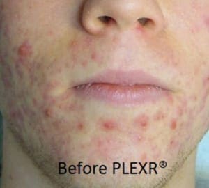 PLEXR | Before & After Photos | Perfect Skin Solutions