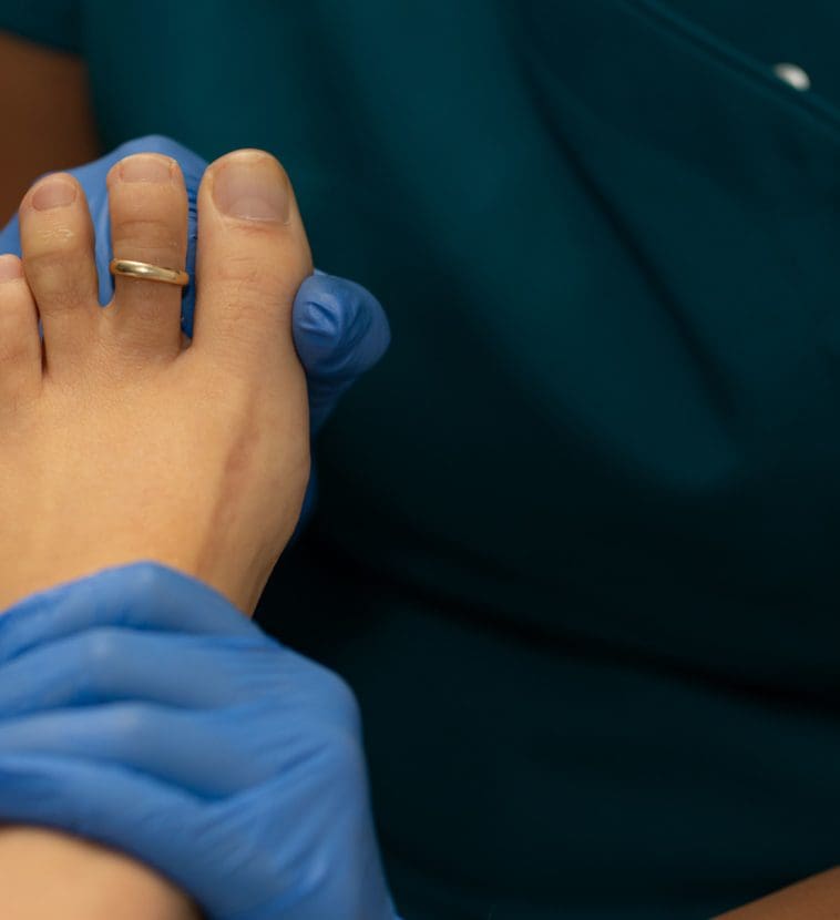 Dry Needling Verruca Removal | Perfect Skin Solutions