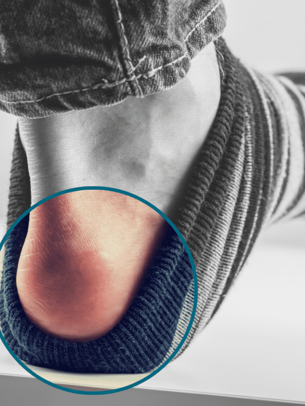 Foot Fillers at Perfect Skin Solutions