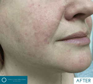 IPL Intense Pulsed Light - Before & After - Perfect Skin Solutions