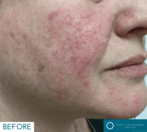 IPL Intense Pulsed Light | Before & After | Perfect Skin Solutions
