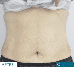 Lipofirm PRO | Before & After Photos | Perfect Skin Solutions