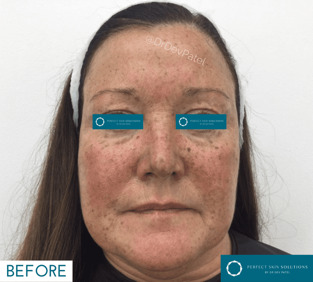 Lumecca Treatments - Before & After - Perfect Skin Solutions