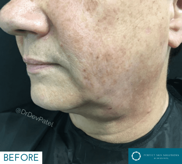 Lumecca Treatments - Before & After - Perfect Skin Solutions