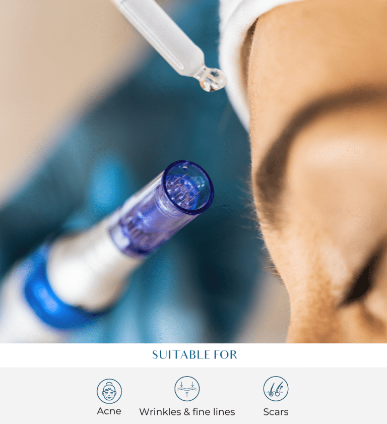 Revitalize Your Skin: A Comprehensive Guide to SkinPen Microneedling