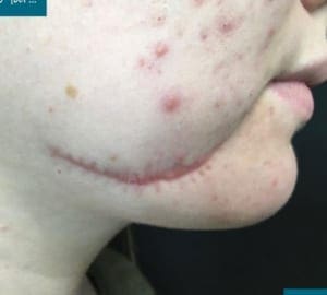 iPRF - Injectable Platelet Rich Plasma | Before & After Photos