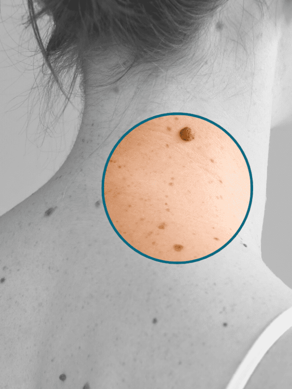 Lesions, Lumps & Bumps - Perfect Skin Solutions