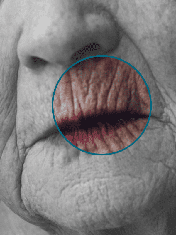 NeoGen PSR Treatment | NeoGen Start from £300 - Portsmouth, UK