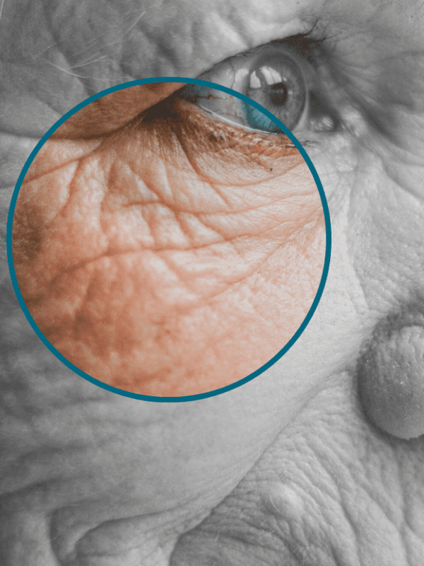 Celluma PRO | LED light therapy | Before & After Photos