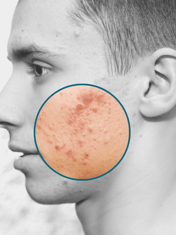 Dermalux Tri-Wave MD LED Phototherapy Treatment | Perfect Skin Solutions