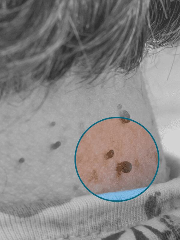 Lesions, Lumps & Bumps - Perfect Skin Solutions