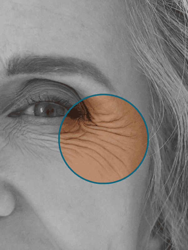 PROFHILO | Before & After Photos | Perfect Skin Solutions