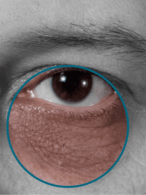 Sunekos Treatment | Before & After Photos