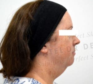 FaceTite Treatment | Before & After Photos | Perfect Skin Solutions