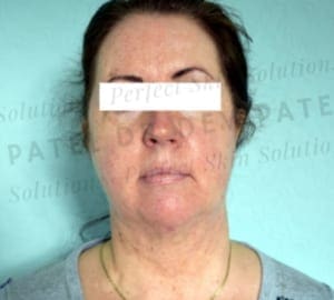 FaceTite Treatment | Before & After Photos | Perfect Skin Solutions