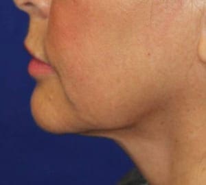 FaceTite Treatment | Before & After Photos | Perfect Skin Solutions