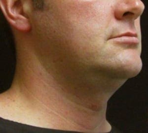 FaceTite Treatment | Before & After Photos | Perfect Skin Solutions