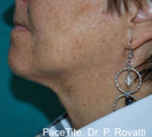 FaceTite Treatment | Before & After Photos | Perfect Skin Solutions