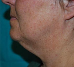 FaceTite Treatment | Before & After Photos | Perfect Skin Solutions