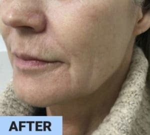 iPixel Skin Resurfacing | Before & After | Perfect Skin Solutions