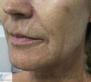 iPixel Skin Resurfacing | Before & After | Perfect Skin Solutions