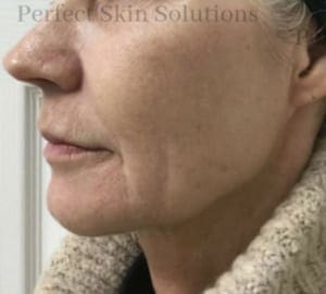 iPixel Skin Resurfacing | Before & After | Perfect Skin Solutions