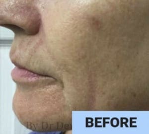 iPixel Skin Resurfacing | Before & After | Perfect Skin Solutions