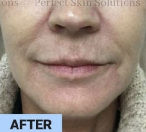 iPixel Skin Resurfacing | Before & After | Perfect Skin Solutions