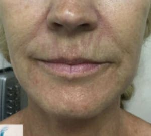 iPixel Skin Resurfacing | Before & After | Perfect Skin Solutions
