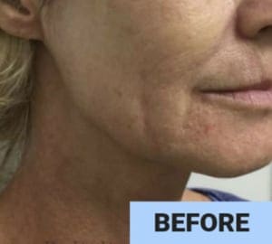 iPixel Skin Resurfacing | Before & After | Perfect Skin Solutions
