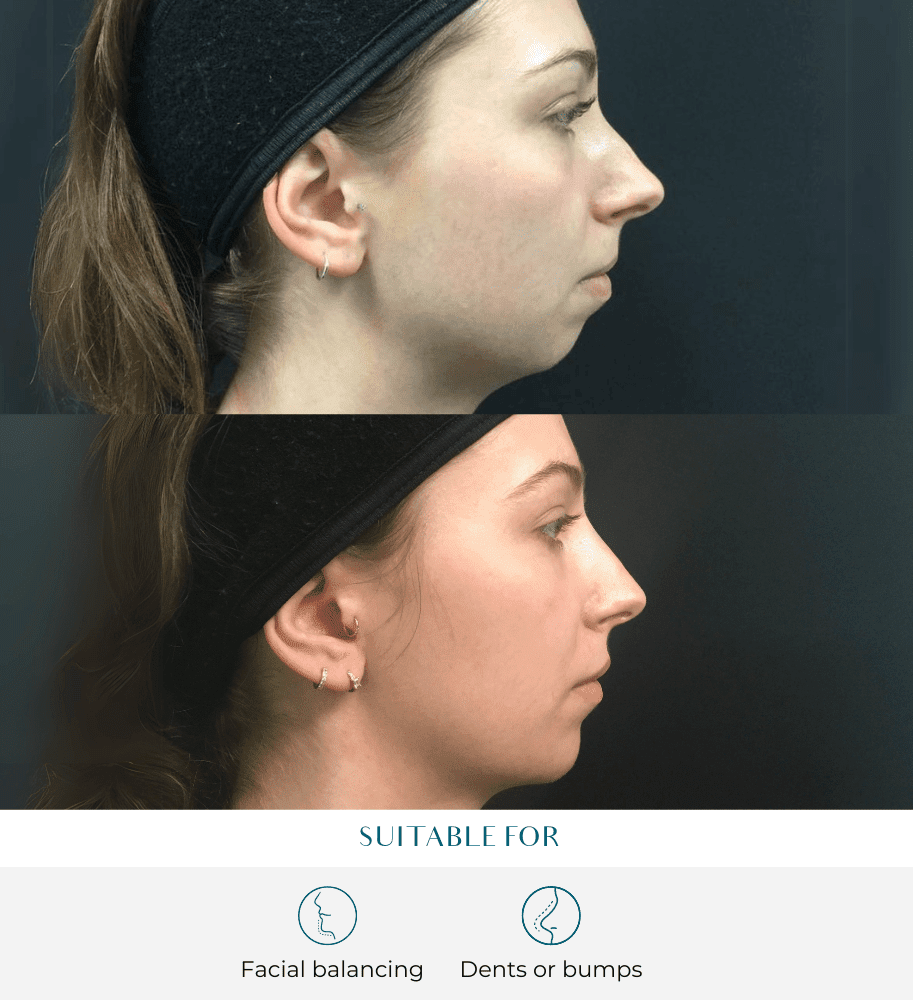 Jawline Fillers | Before & After Photos | Perfect Skin Solutions