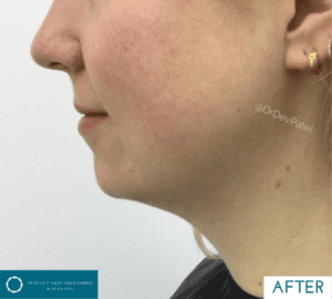 Lipofirm PRO | Before & After Photos | Perfect Skin Solutions