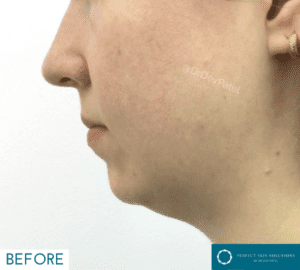 Lipofirm PRO | Before & After Photos | Perfect Skin Solutions