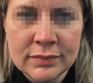 PROFHILO | Before & After Photos | Perfect Skin Solutions