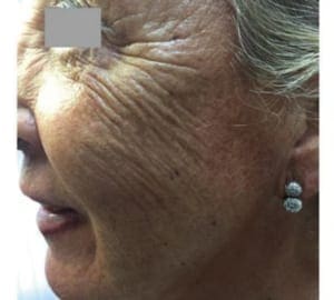 PROFHILO | Before & After Photos | Perfect Skin Solutions