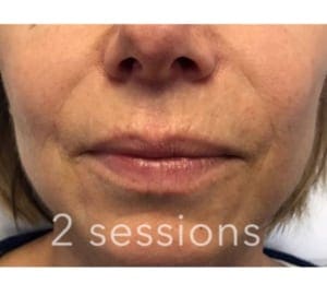 Sunekos - Before & After - Perfect Skin Solutions