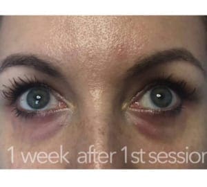 Sunekos Treatment | Before & After Photos