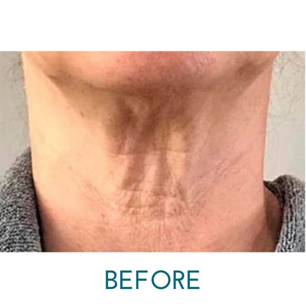 Endolift Treatment | Before & After | Perfect Skin Solutions