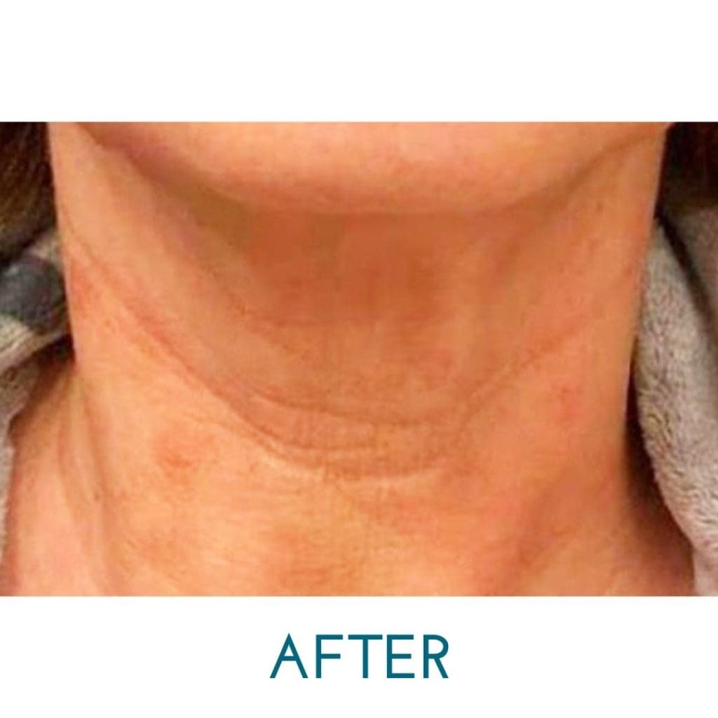 Endolift Treatment - Non-Surgical & Laser Facial Rejuvenation