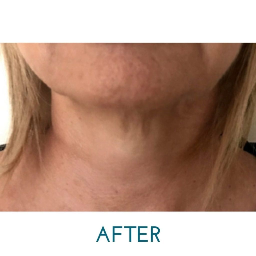 Endolift Treatment | Before & After | Perfect Skin Solutions